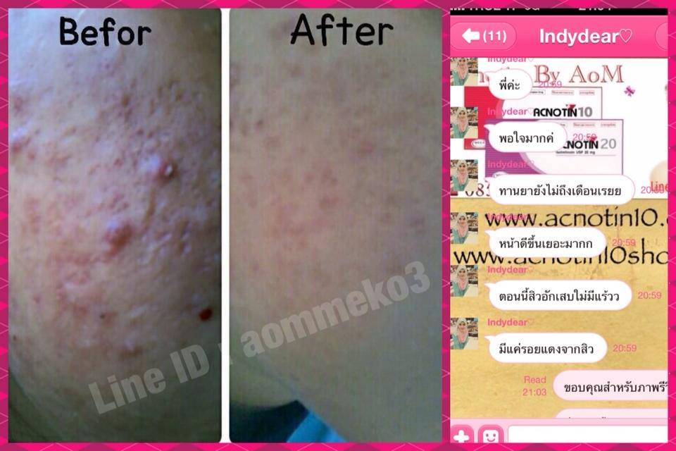 ACNOTIN แอคโนติน ราคาถูก ส่งไวภายใน 1 วัน by AoM